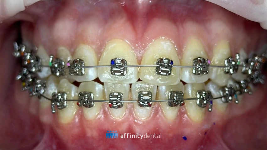 Self-Ligating Metal Braces – Orthodontic Treatment Progress - Affinity ...